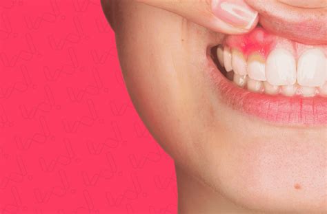 Como tirar tártaro dos dentes opções caseiras e naturais