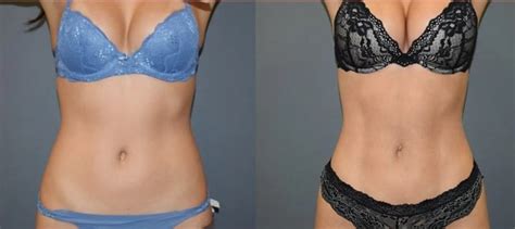 Lipo Hd Antes E Depois Resultados Incr Veis Da Cirurgia
