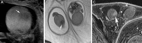 Testicular Germ Cell Tumors Classification Pathologic Features Imaging Findings And