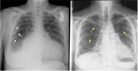 Fundamental Radiological Findings Algorithmic Approach To Lung
