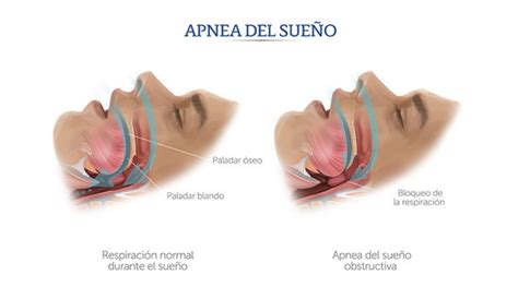 Apnea del sueño y dam