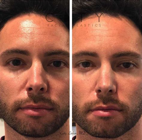 Liquid Rhinoplasty New York City City Facial Plastics