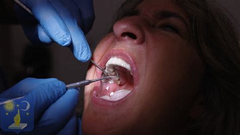Implant Dentaire Basal Pour Parodontite Implant Basal France