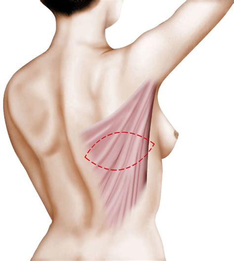 Reconstruction mammaire par lambeau de grand dorsal à Paris Dr Ozil