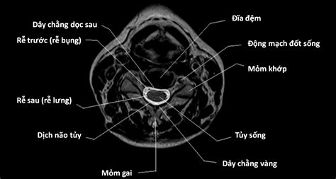 Giải Phẫu MRI Cột Sống Bài giảng CĐHA