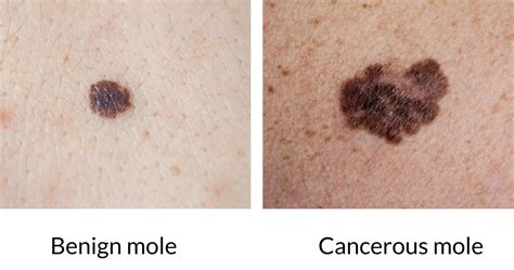 Stages Melanoma Skin Cancer Moles