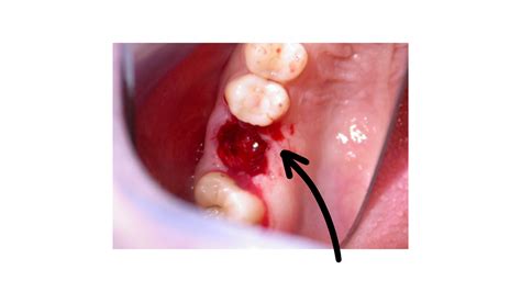 What Does A Blood Clot After Tooth Extraction Look Like Preventing