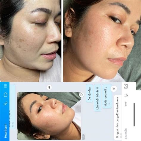 Top 7 Spa trị nám hiệu quả nhất quận Tân Phú TP HCM toplist vn