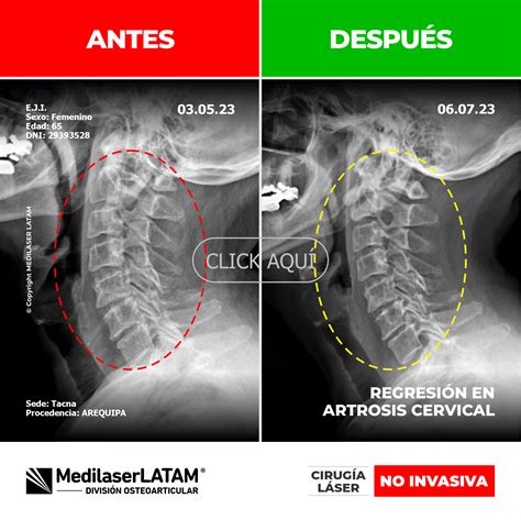 Eleana Jimenez Regresi N En Artrosis Cervical Medilaser Per