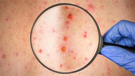 Mpox qué es la viruela del mono cuáles son sus síntomas y cómo puedes