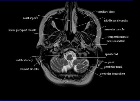 View Brain Anatomy In Mri PNG