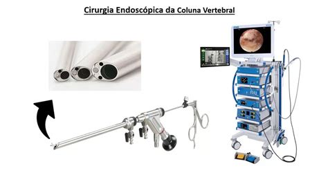 Cirurgia endoscópica da coluna vertebral Dr Vinícius Orso