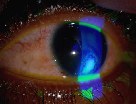 Corneal Ulcers Flashcards Quizlet
