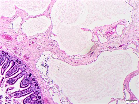 Pathology Outlines Lymphangioma