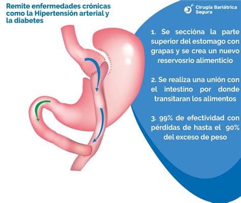 Bypass Gástrico GMEDIQ cirugía bariátrica Quito y Ambato 1