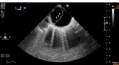 Cureus Transesophageal Echocardiogram Still A Powerful Tool In The
