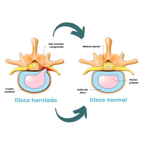 Información Curso Hernia discal