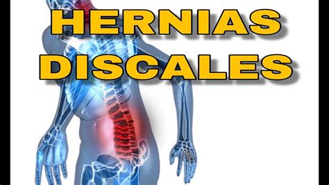 COMO MEJORAR SIN CIRUGIA Hernias Discales Sintomas Recuperacion
