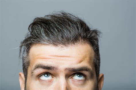 Perte de cheveux chez l homme Clinique Médico Derma