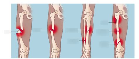 Fracture Types Diagram Quizlet