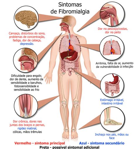 Terapia Manual Para Fibromialgia Recursos No Tratamento