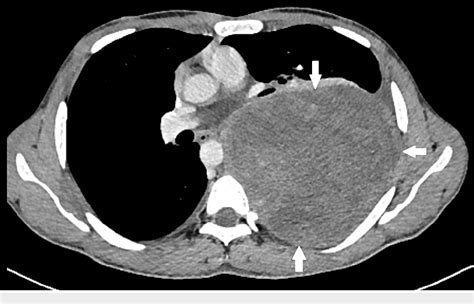 Figure 1 From A Rare Case Of Primary Pleural Neurofibroma Semantic