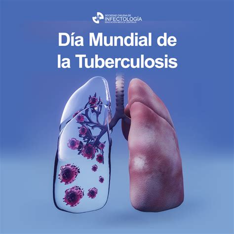 Día Mundial de la Tuberculosis SOCHINF