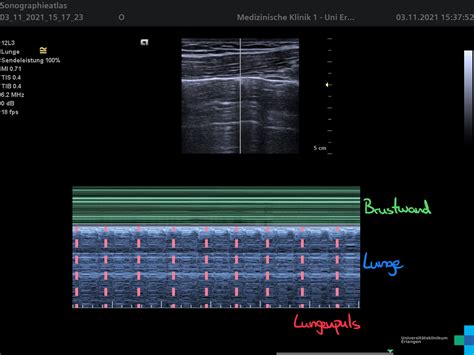 Normalbefund Pleura Sonographieatlas Erlangen
