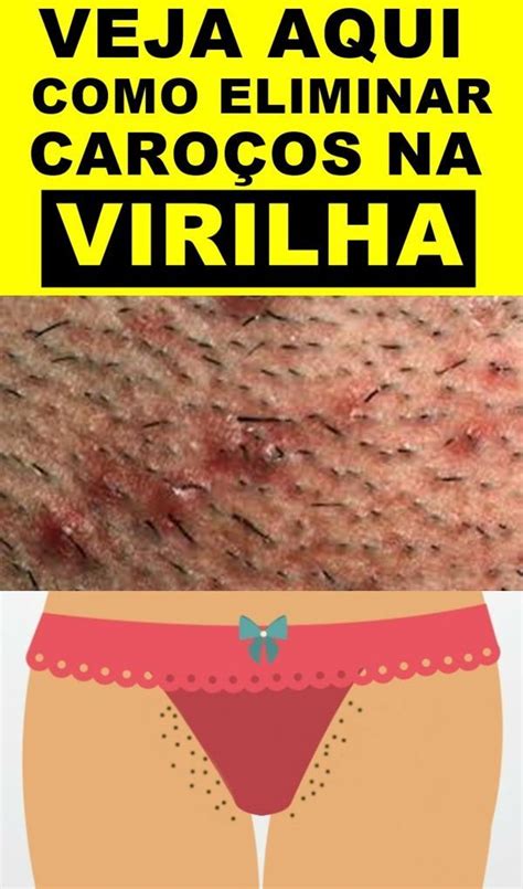 Bolha na virilha o que é e como eliminá las Cuidado Amazon beauty