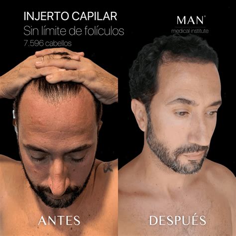 Evolución del injerto capilar mes a mes cómo es el proceso