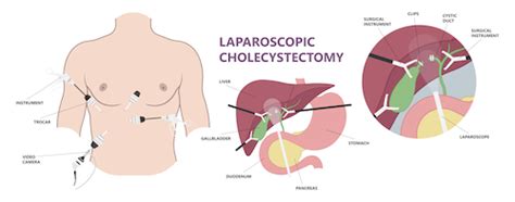 Gallbladder Removal Before And After