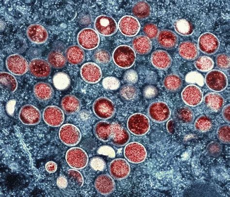 Saúde Pública OMS confirma primeiro caso da nova variante do mpox fora