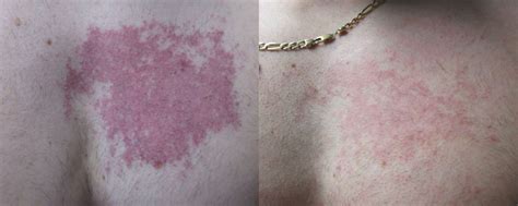 Port Wine Birthmark On Leg