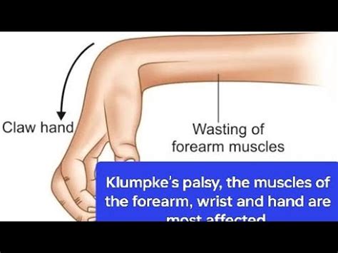 Klumpke S Palsy English Lecture Muscles Of Forearm Wrist And Hand