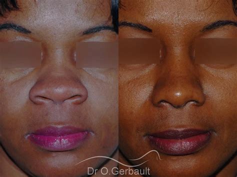 Rhinoplastie avant après photos et exemples de nez refaits