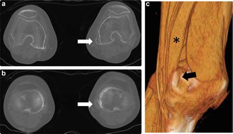 Preoperative Computed Tomography CT Images Preoperative CT Images