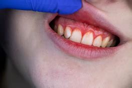 Feridas na boca Conheça as causas e saiba como tratar MaisOdonto