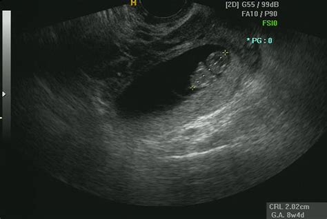 9 Week Ectopic Pregnancy Ultrasound