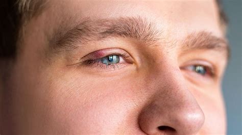 Eye Infections Symptoms Types Treatment Prevention Online