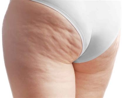 The Ultimate Guide To Get Rid Of Cellulite Naturally Moody Sisters