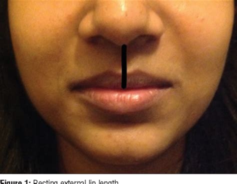 Figure 1 From Evaluation Of Upper Lip Elevation To The Ideal Lip Height