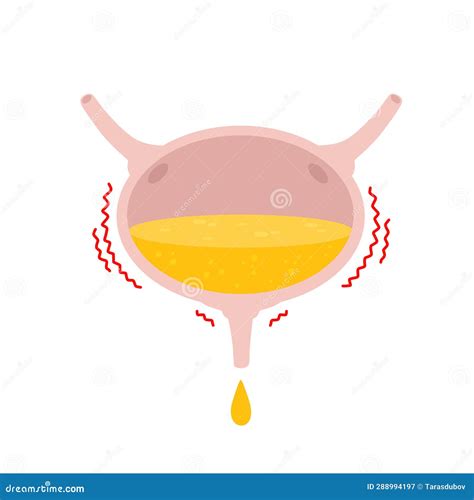 Bexiga Hiperativa Sobrecarga Urinária Ilustração do Vetor Ilustração