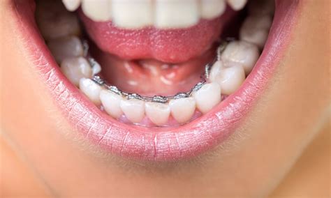 Cuánto cuesta ponerse brackets en Estados Unidos Precios 2023
