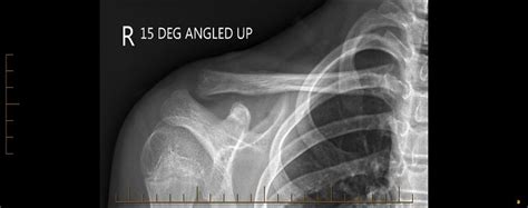 Clavicle Fractures Dr David Duckworth