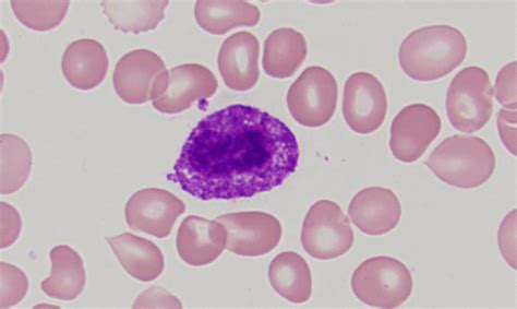 Pathology Outlines Mast Cells