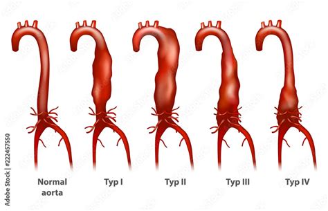 Abdominal Aortic Aneurysm Thoracoabdominal Crawford Classification