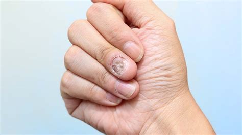 Fotos De Onicomicosis Hongos En Las U As Md Sa De