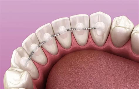 ortodoncia invisible Arco Clínica Dental