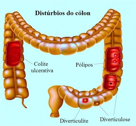 Sangue Nas Fezes Oculto Ou Vermelho Vivo Exames E Colonoscopia