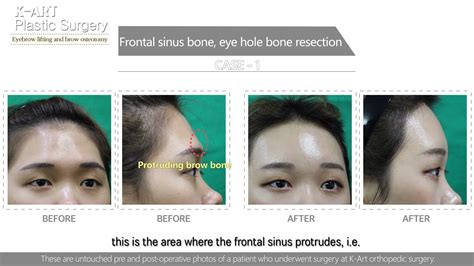 The Surprising Effects Of Eyebrow Eyehole Bone Cutting